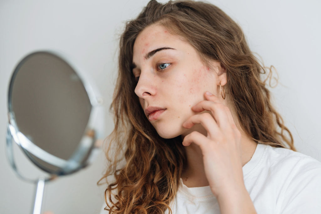 Button and redness on the face: rosacea or acne? Everything you need to ...